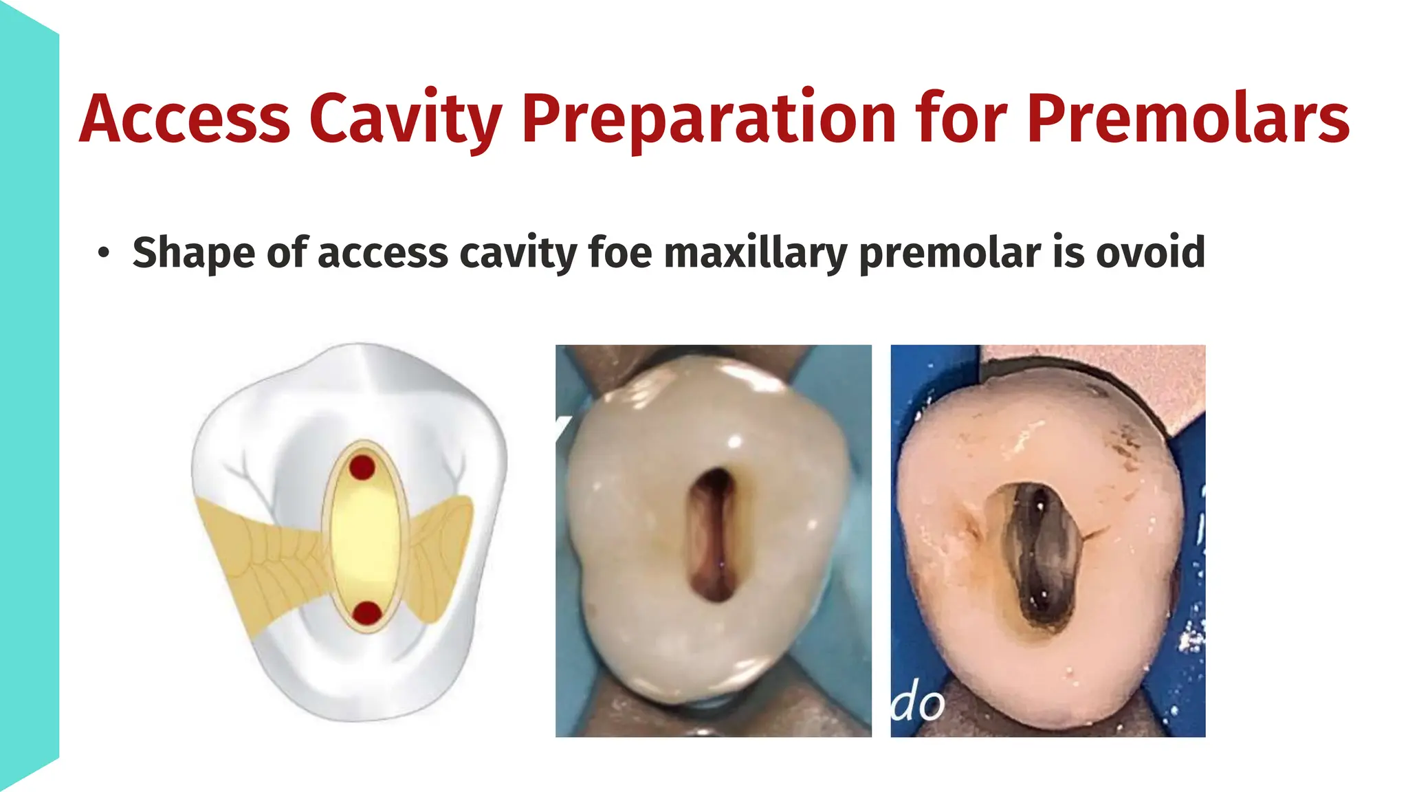 Principles of Access cavity preparation.pptx
