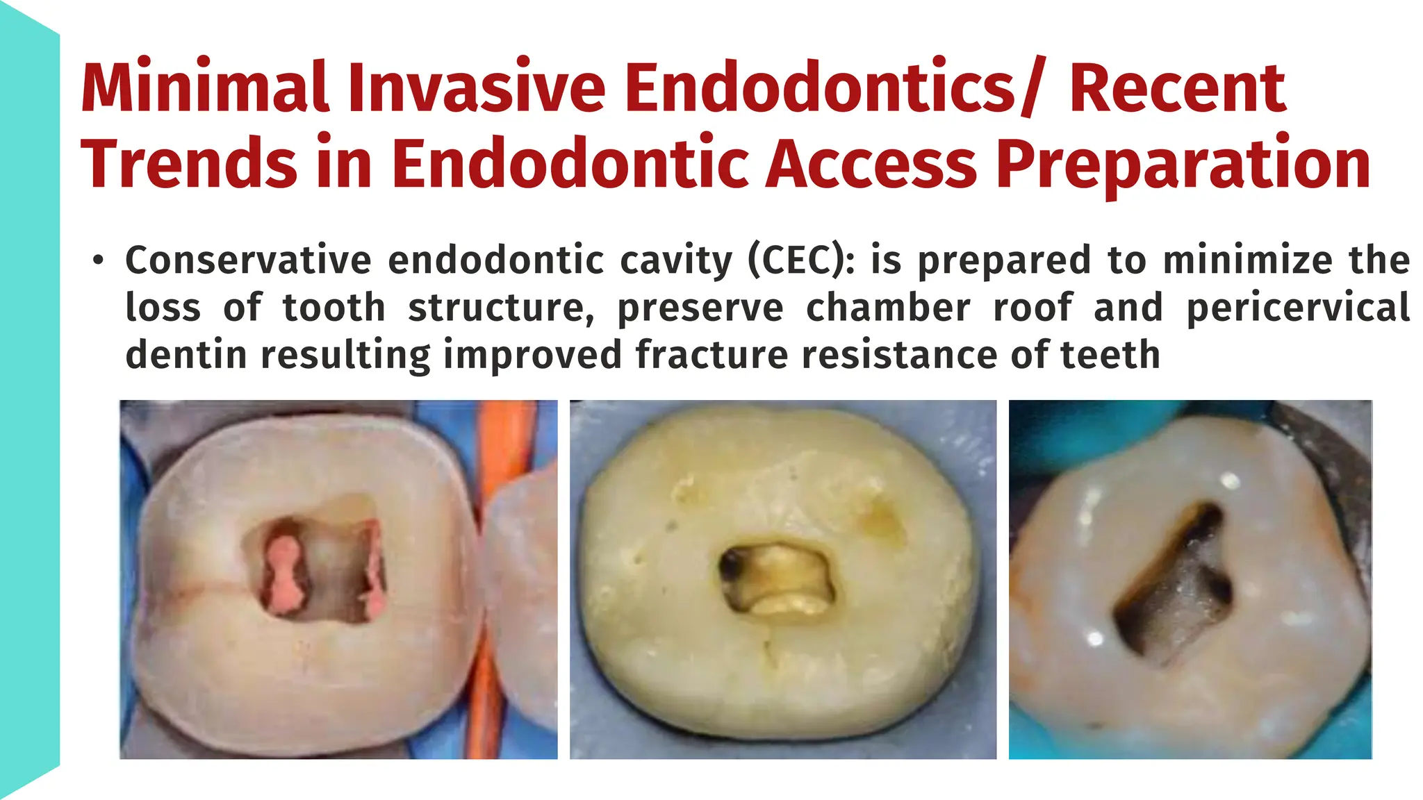 Principles of Access cavity preparation.pptx
