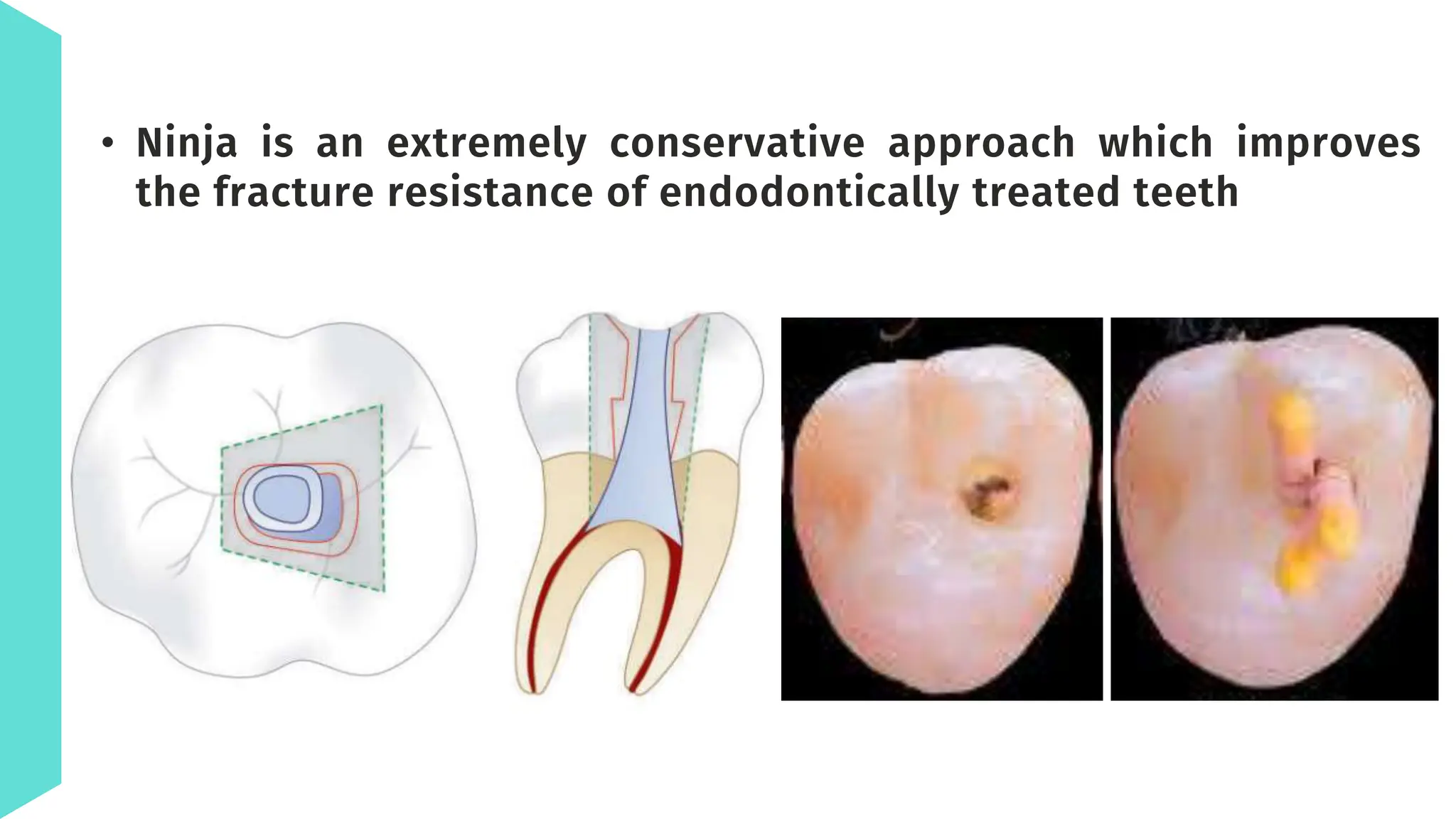 Principles of Access cavity preparation.pptx