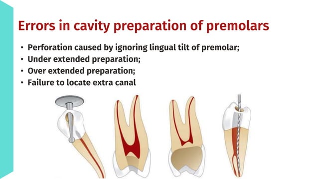 Principles of Access cavity preparation.pptx | Dental Health | Diseases ...