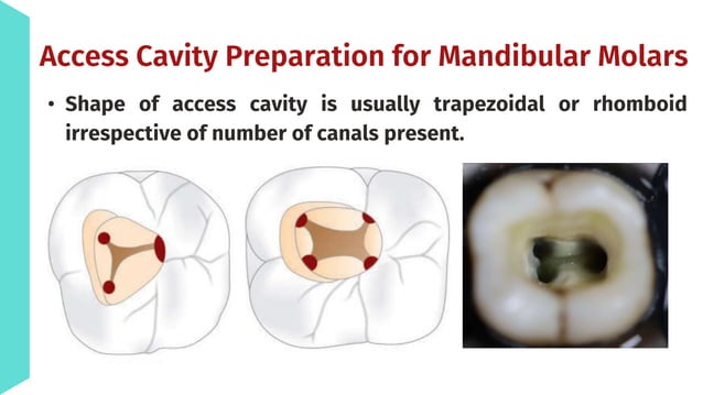 Principles of Access cavity preparation.pptx | Dental Health | Diseases ...