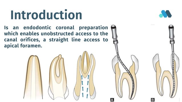 Principles of Access cavity preparation.pptx | Dental Health | Diseases ...