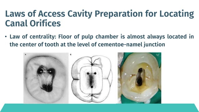 Principles of Access cavity preparation.pptx | Dental Health | Diseases ...