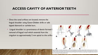 Access Cavity Preparation (2).pptxin endodontic | PPTX