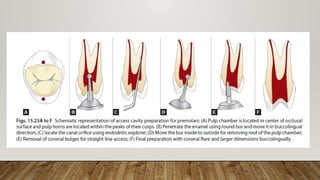 Access Cavity Preparation (2).pptxin endodontic | PPTX
