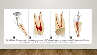 Access Cavity Preparation (2).pptxin endodontic | PPTX