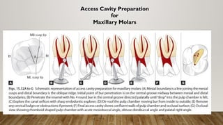 Access Cavity Preparation (2).pptxin endodontic | PPTX