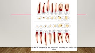 Access Cavity Preparation (2).pptxin endodontic | PPTX
