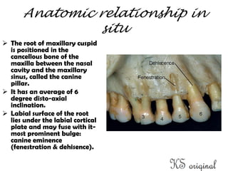 Access cavity preparation for maxillary canines | PPTX