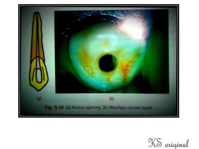 Access cavity preparation for maxillary canines | PPTX