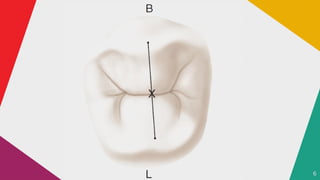 Access cavity preparation in posterior teeth | PDF
