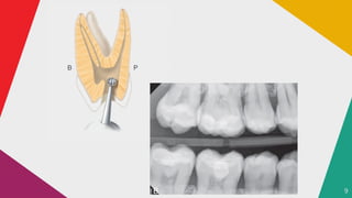 Access cavity preparation in posterior teeth | PDF