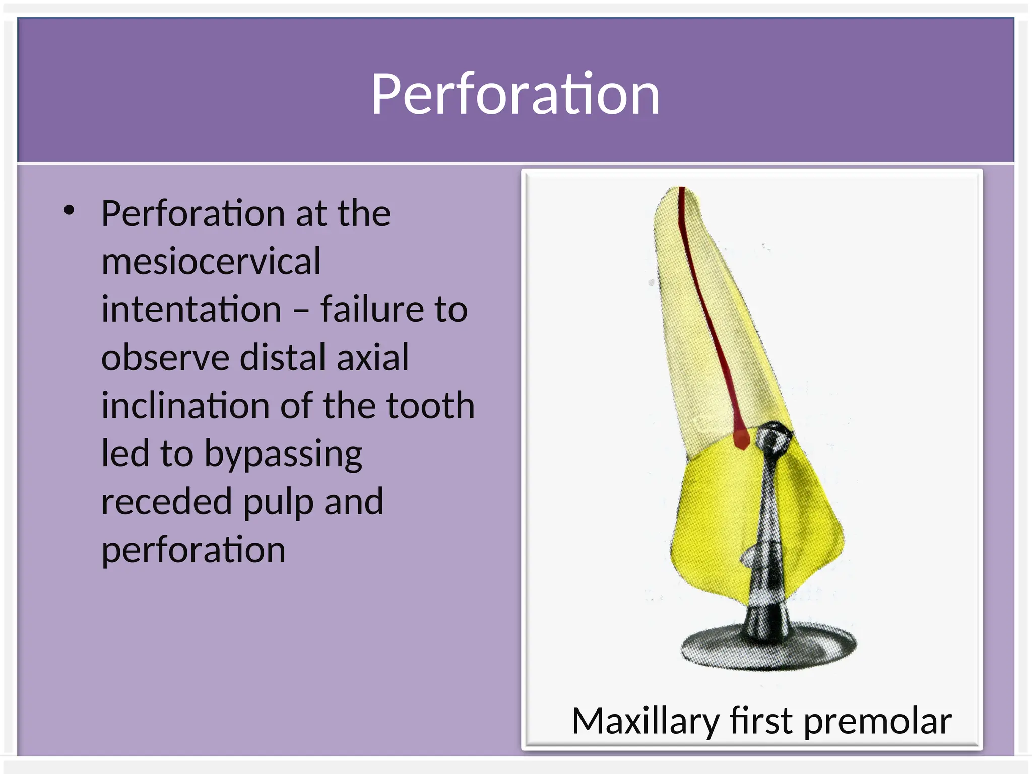 Endodontic access cavity preparation design | PPT