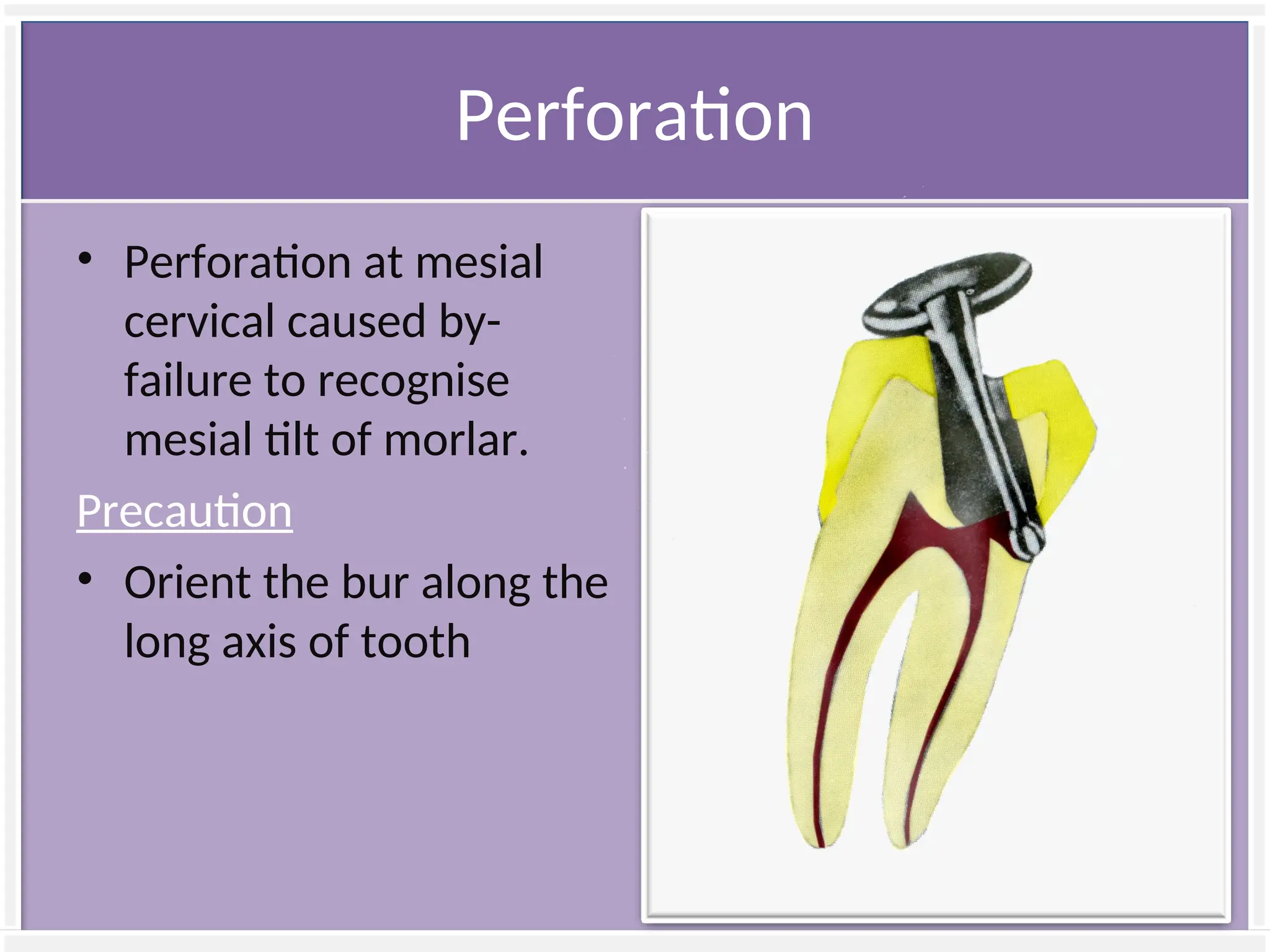 Endodontic access cavity preparation design | PPT