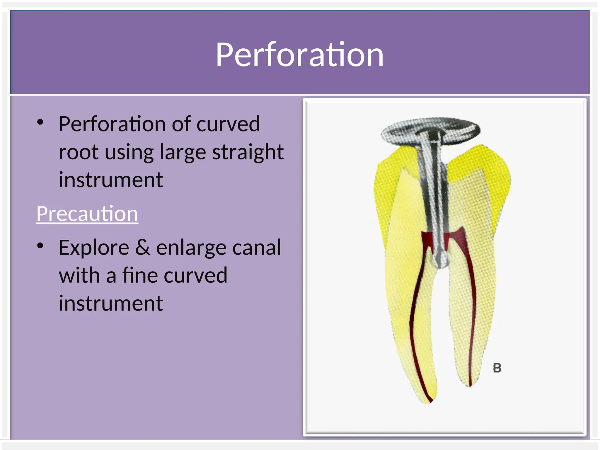 Endodontic access cavity preparation design | PPT