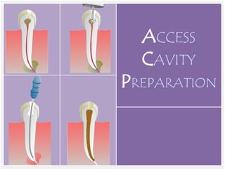 Endodontic access cavity preparation design | PPT