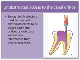 Endodontic access cavity preparation design | PPT