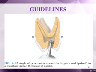 Access cavity preparation posteriors | PPT