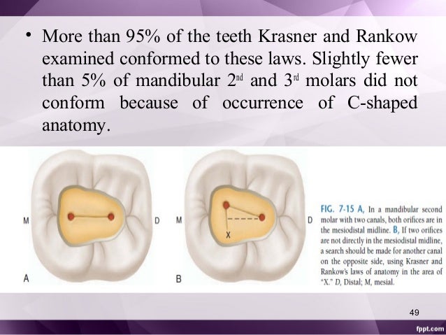 Access cavity preparation posteriors