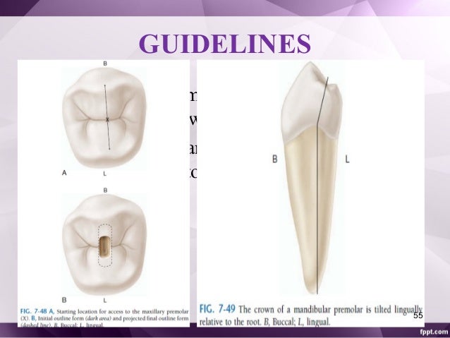 Access cavity preparation posteriors