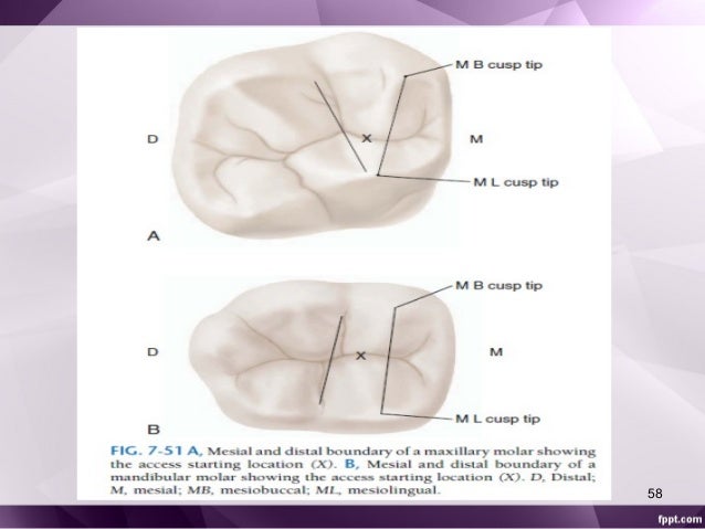 Access cavity preparation posteriors