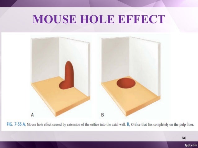 Access cavity preparation posteriors