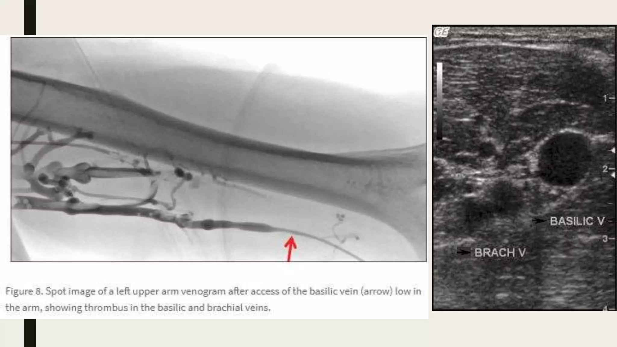 Access Decisions For Venous Interventions Ppt