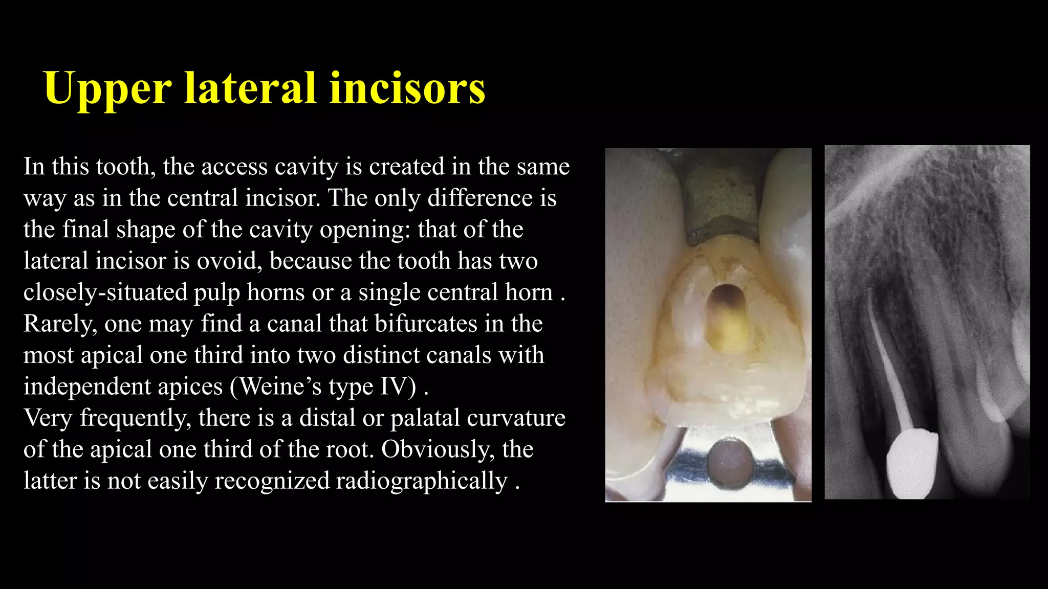 Access opening in anterior teeth | PDF