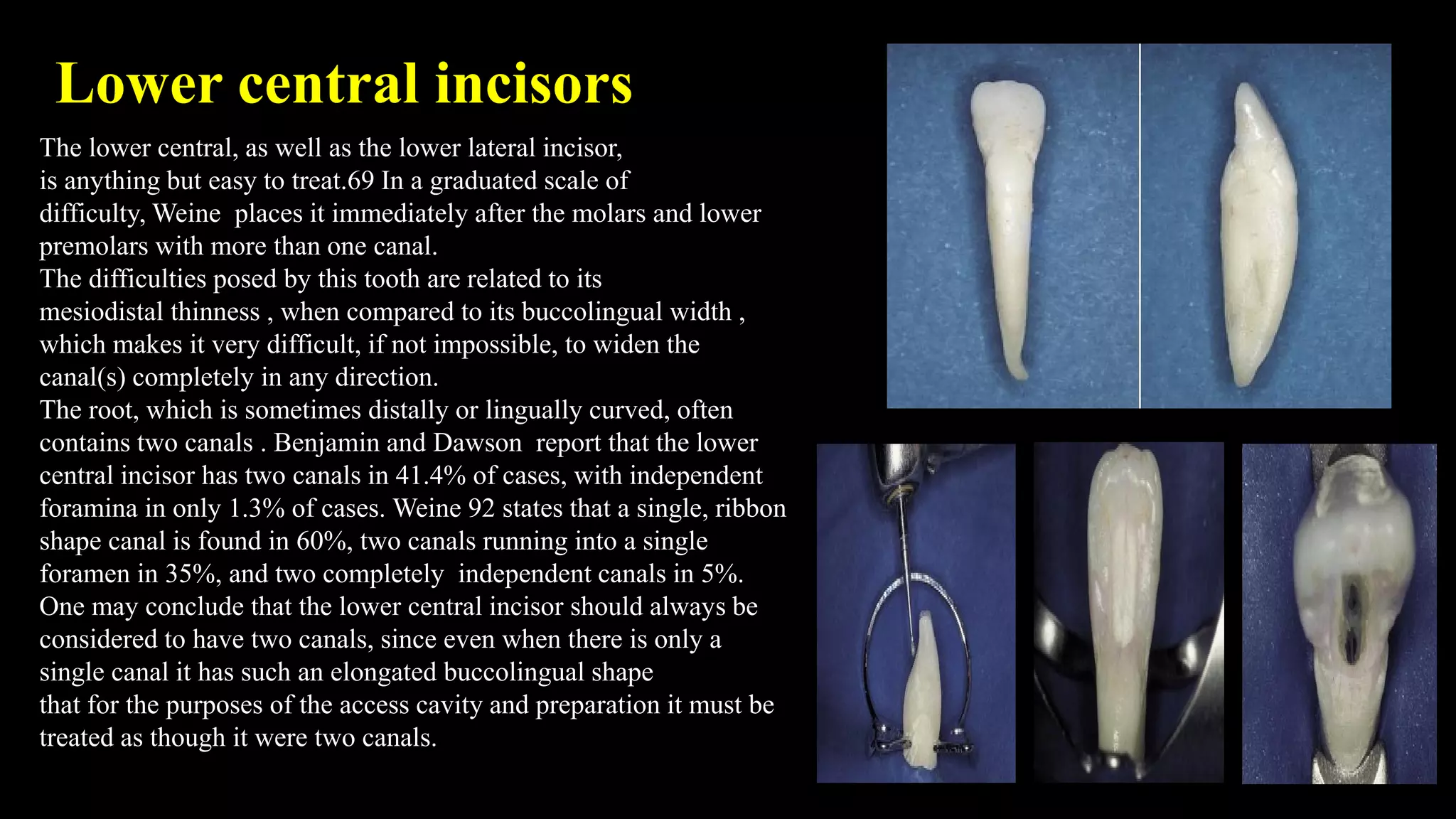 Access opening in anterior teeth | PDF