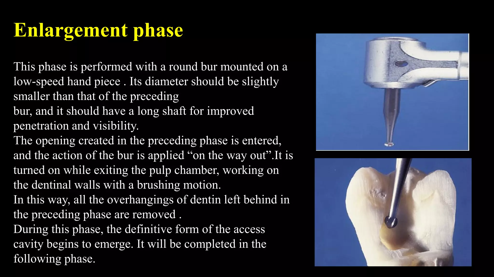 Access opening in anterior teeth | PDF