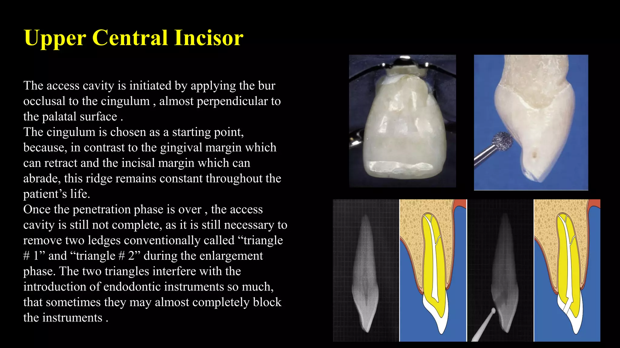Access opening in anterior teeth | PDF