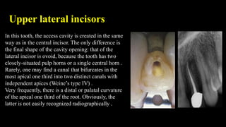 Access opening in anterior teeth | PDF