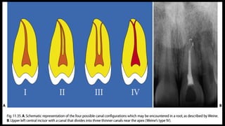 Access opening in anterior teeth | PDF