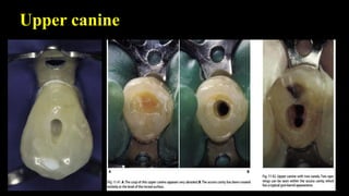 Access opening in anterior teeth | PDF
