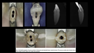 Access opening in anterior teeth | PDF