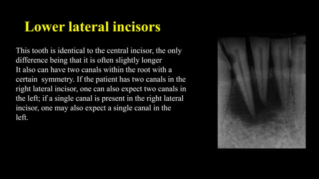 Access opening in anterior teeth | PDF