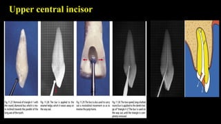 Access opening in anterior teeth | PDF