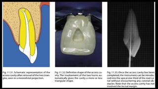 Access opening in anterior teeth | PDF