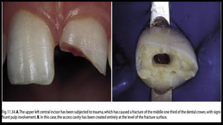 Access opening in anterior teeth | PDF
