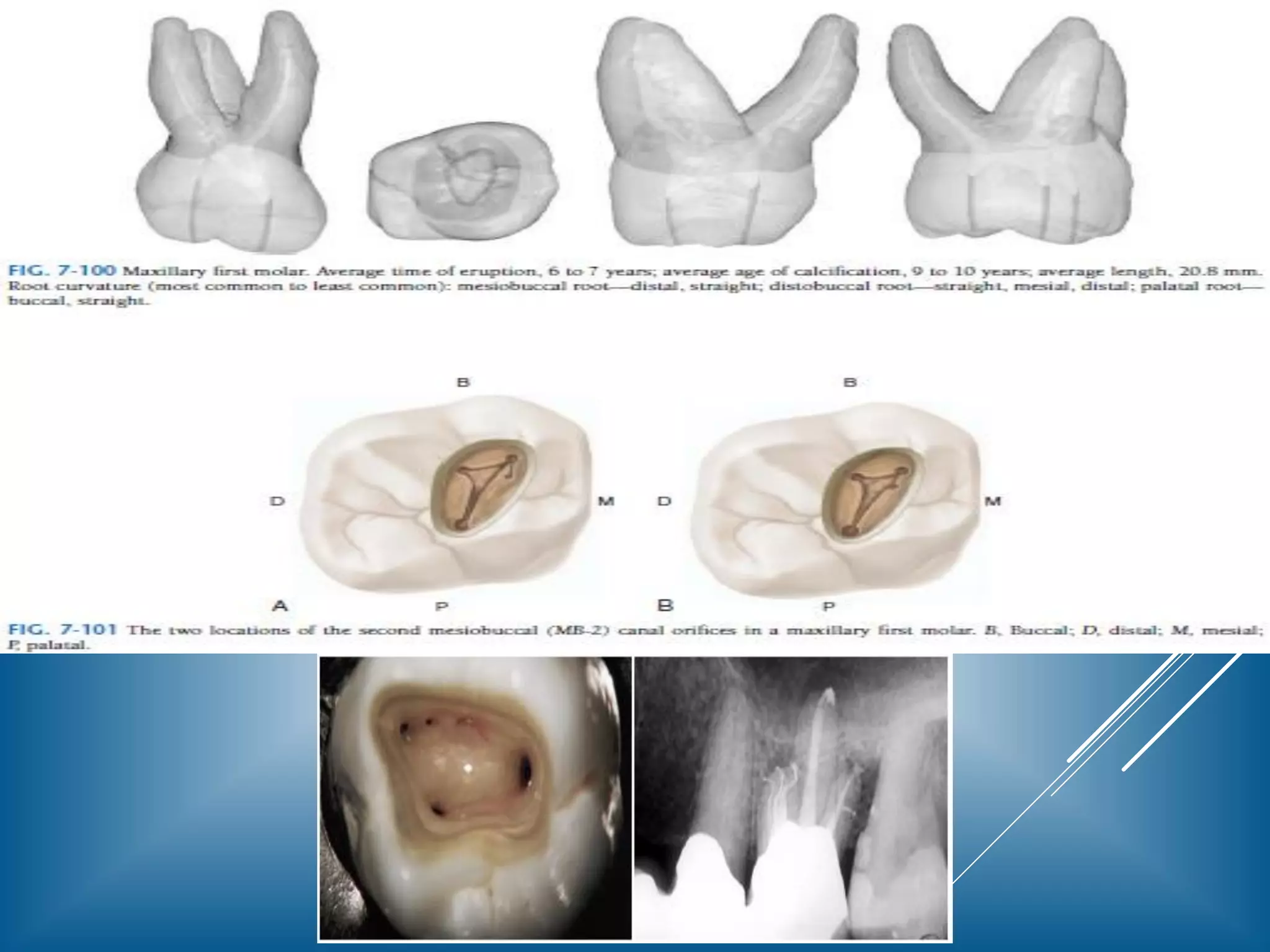Access opening of molar teeth | PDF