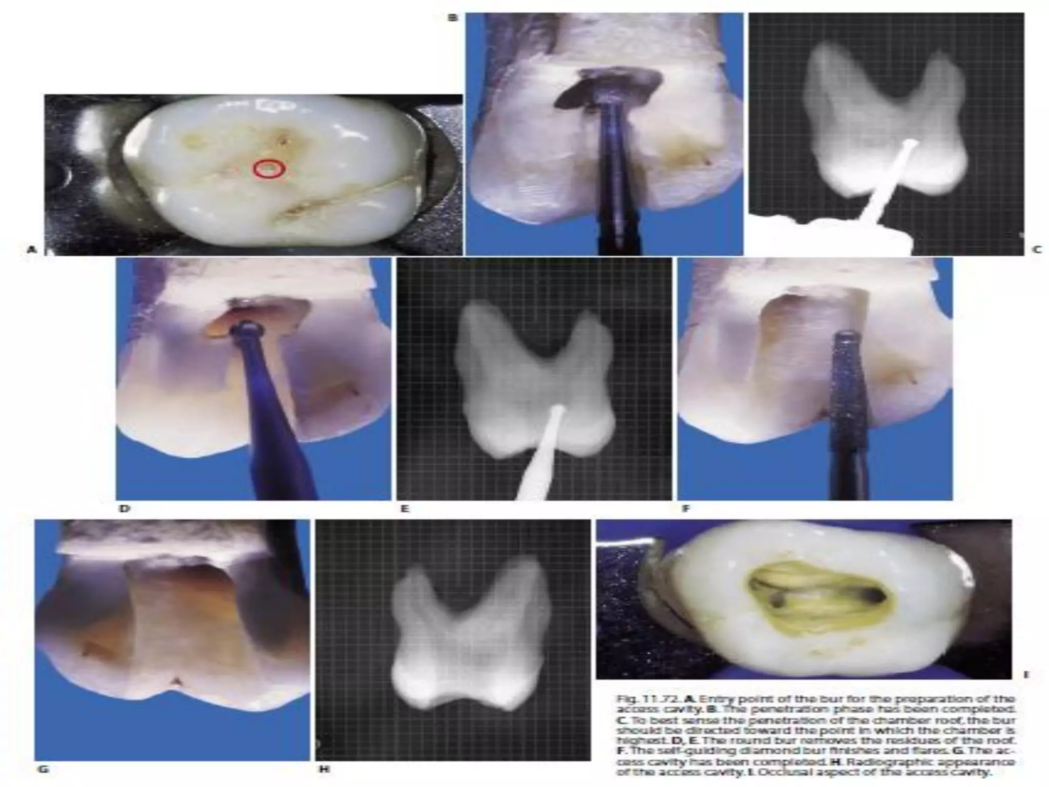 Access opening of molar teeth | PDF