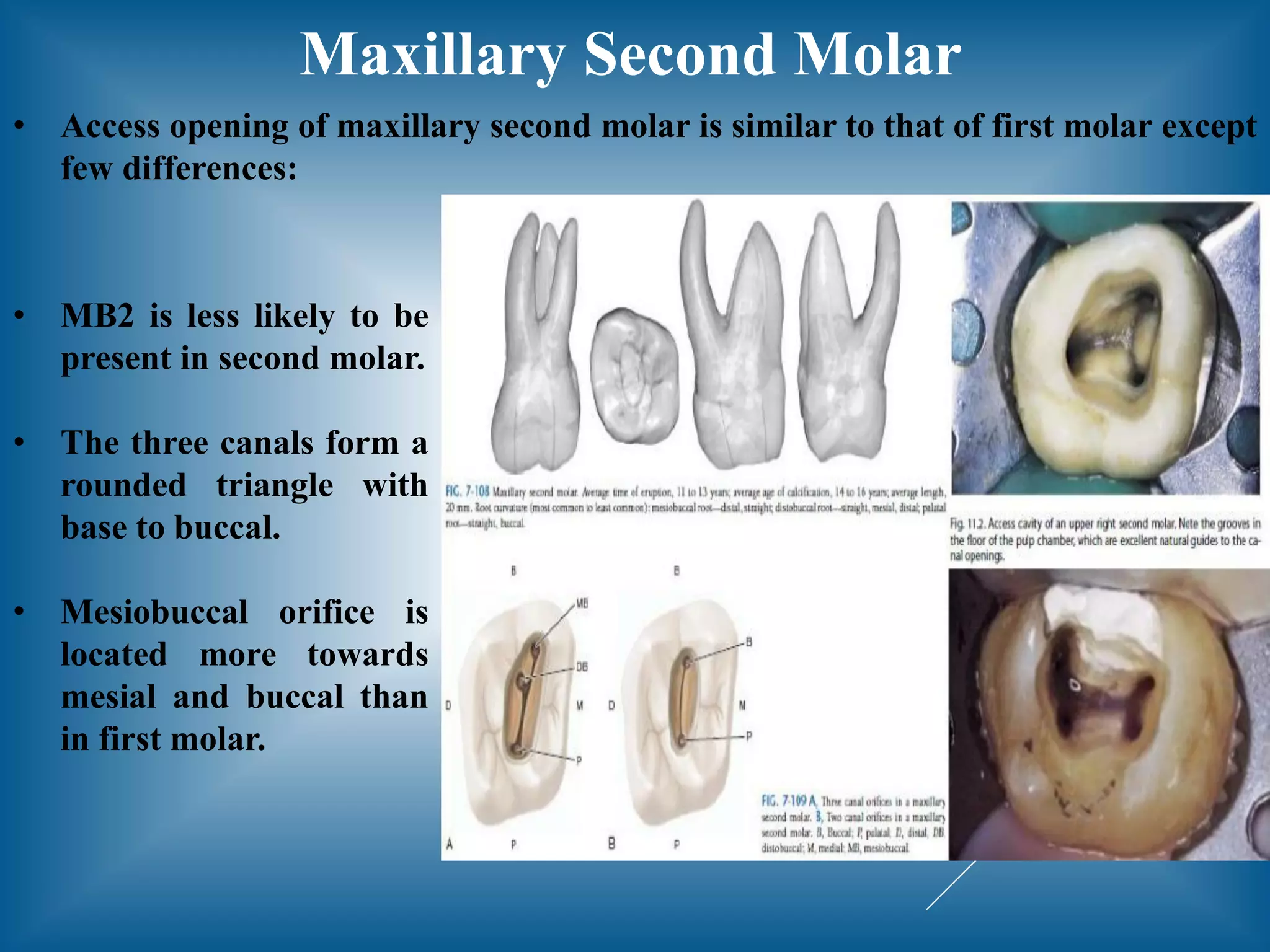 Access opening of molar teeth | PDF