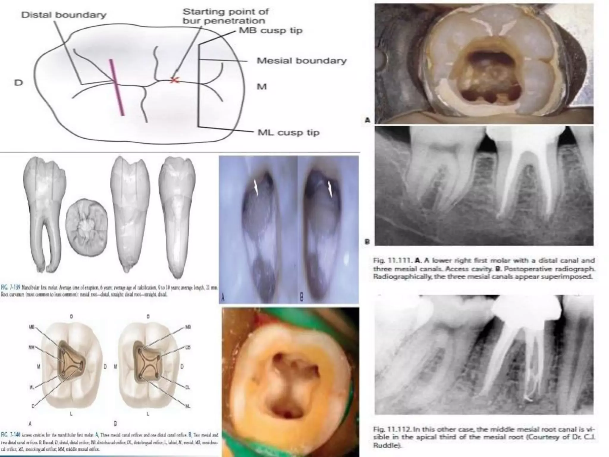 Access opening of molar teeth | PDF