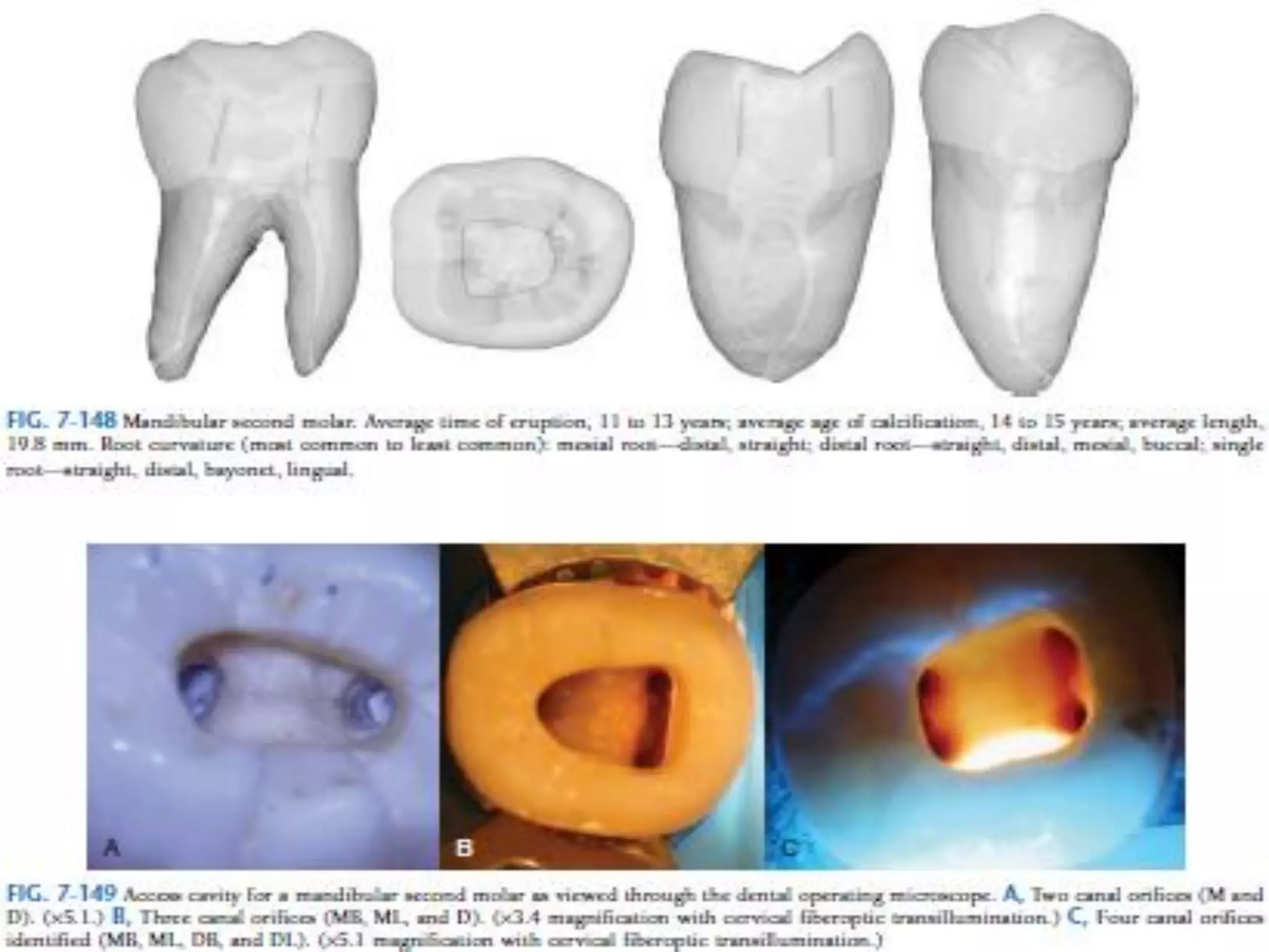 Access opening of molar teeth | PDF