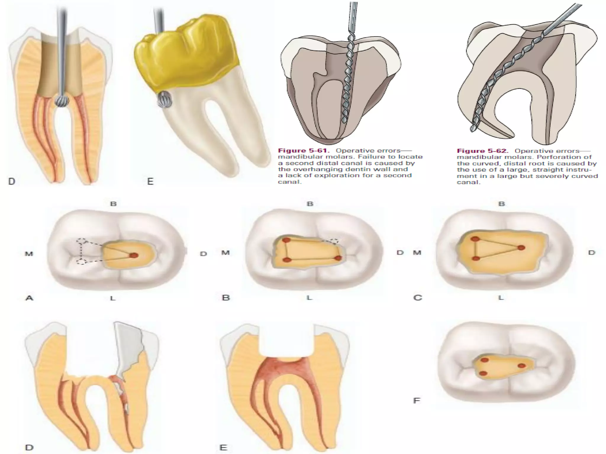 Access opening of molar teeth | PDF