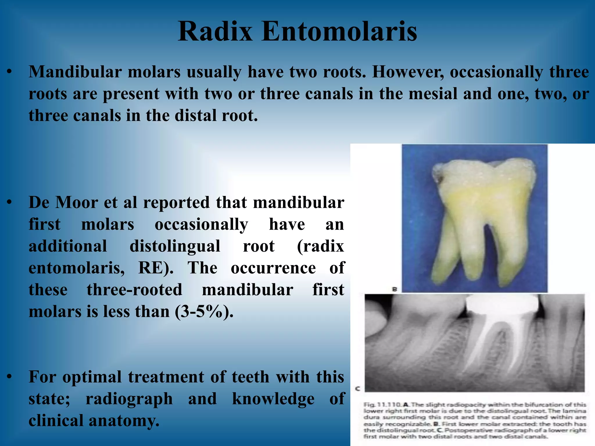 Access opening of molar teeth | PDF