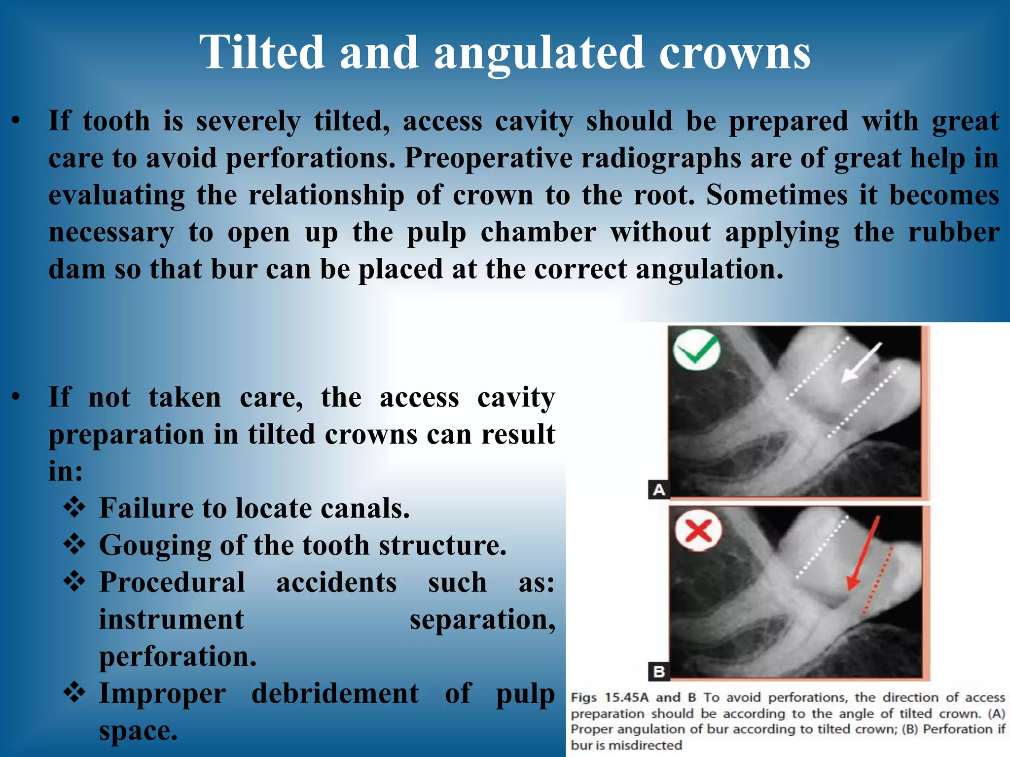 Access opening of molar teeth | PDF