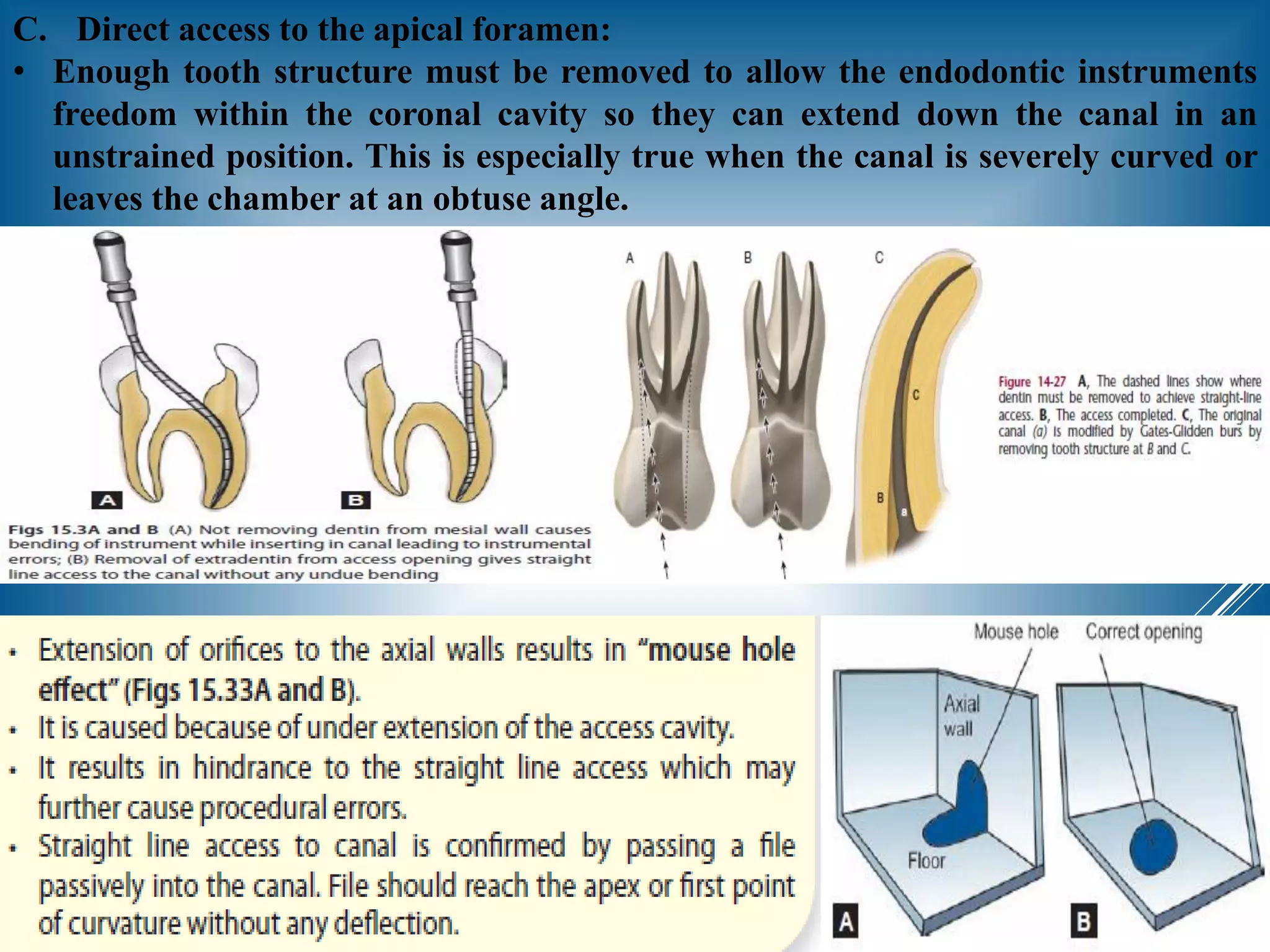 Access opening of molar teeth | PDF