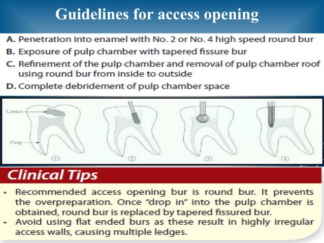 Access opening of molar teeth | PDF
