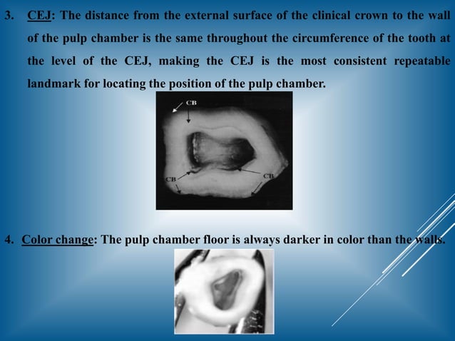 Access opening of molar teeth | PDF